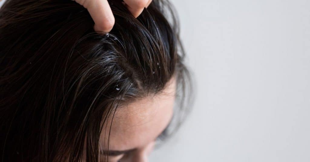 ¿Me estoy quedando calvo? Tipos de entradas en el cabello