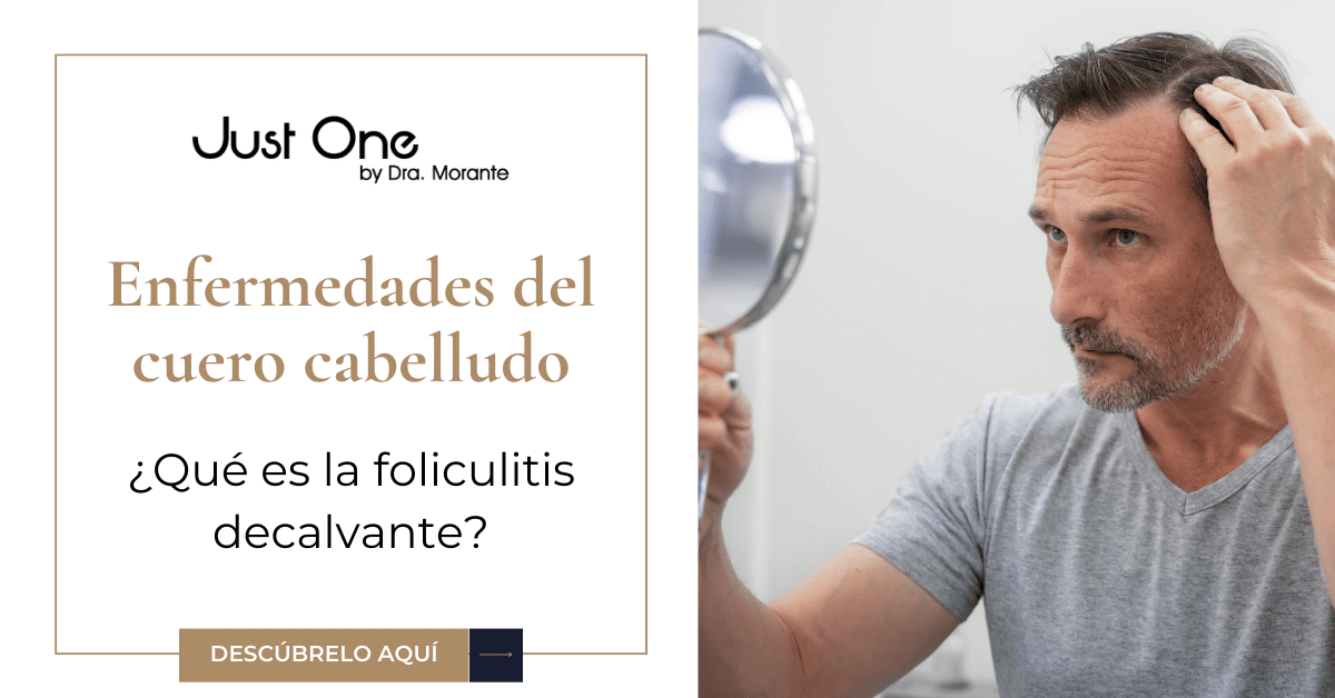 Foliculitis decalvante: una alopecia que puede ser irreversible