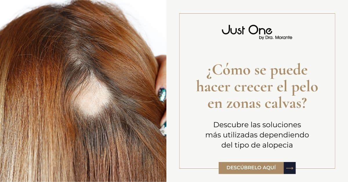 Tratamientos para hacer crecer el pelo en zonas calvas I Just One